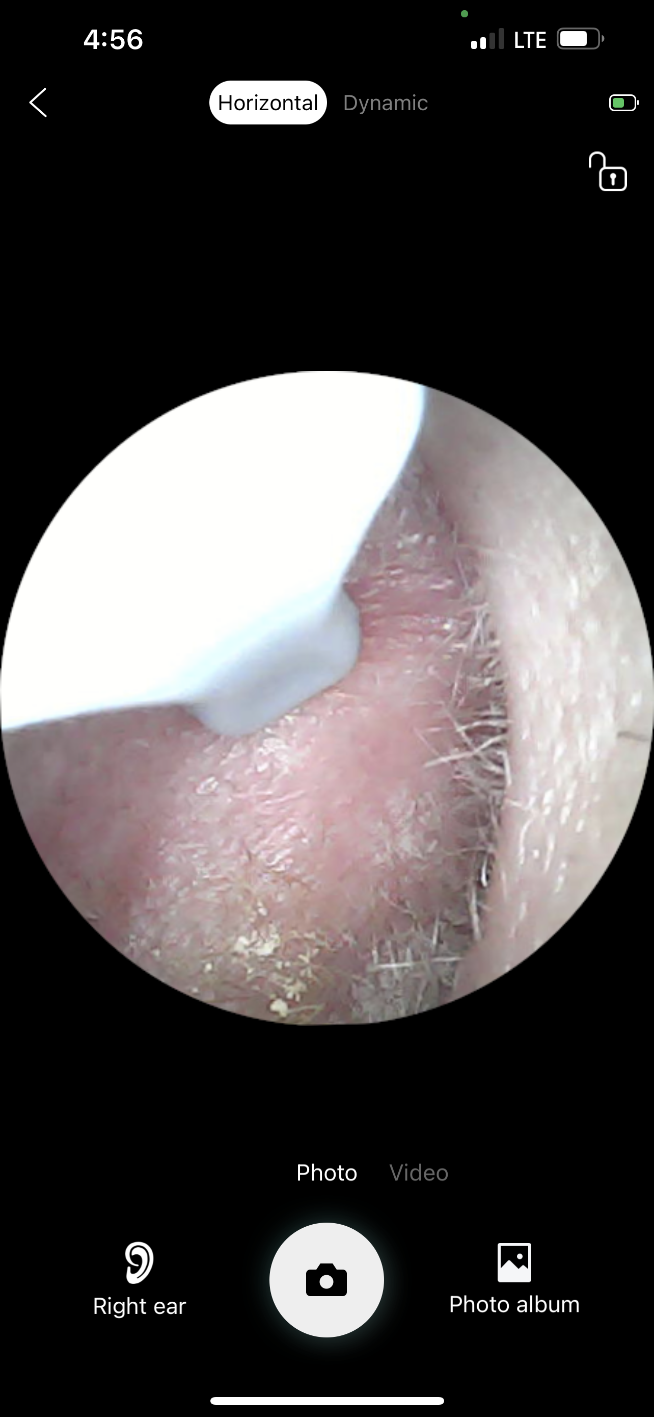 Ear Candling – Reflexology Denver