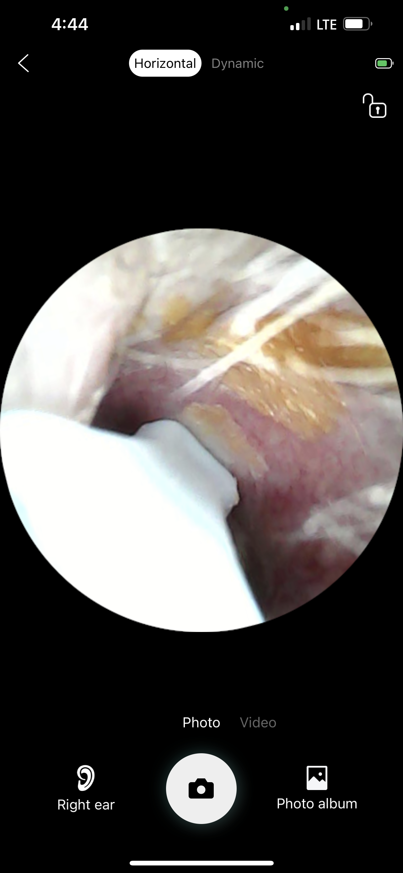 Ear Candling – Reflexology Denver